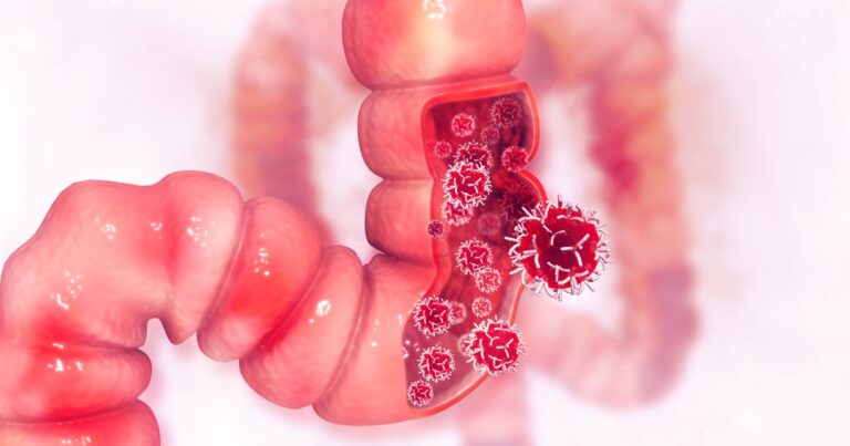 Colon Cancer: Recognizing The Signs | Fast CE For Less, Inc.